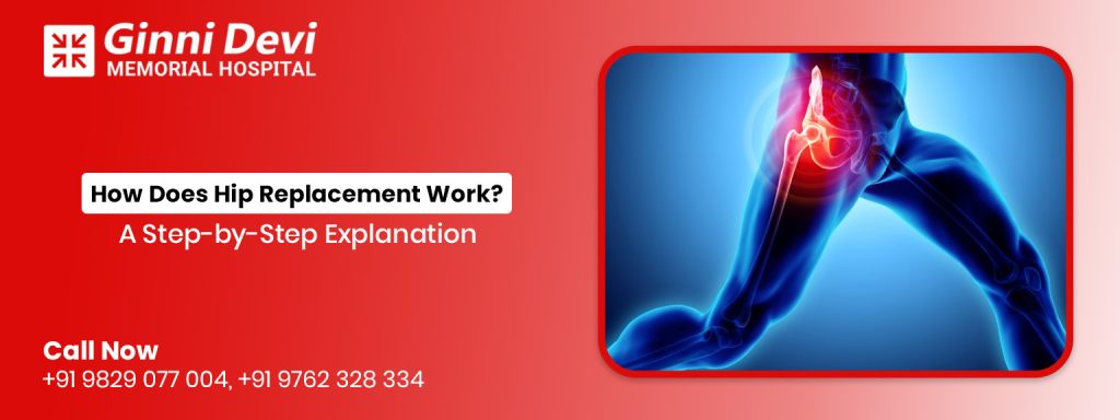How Does Hip Replacement Work? Step-by-Step Procedure